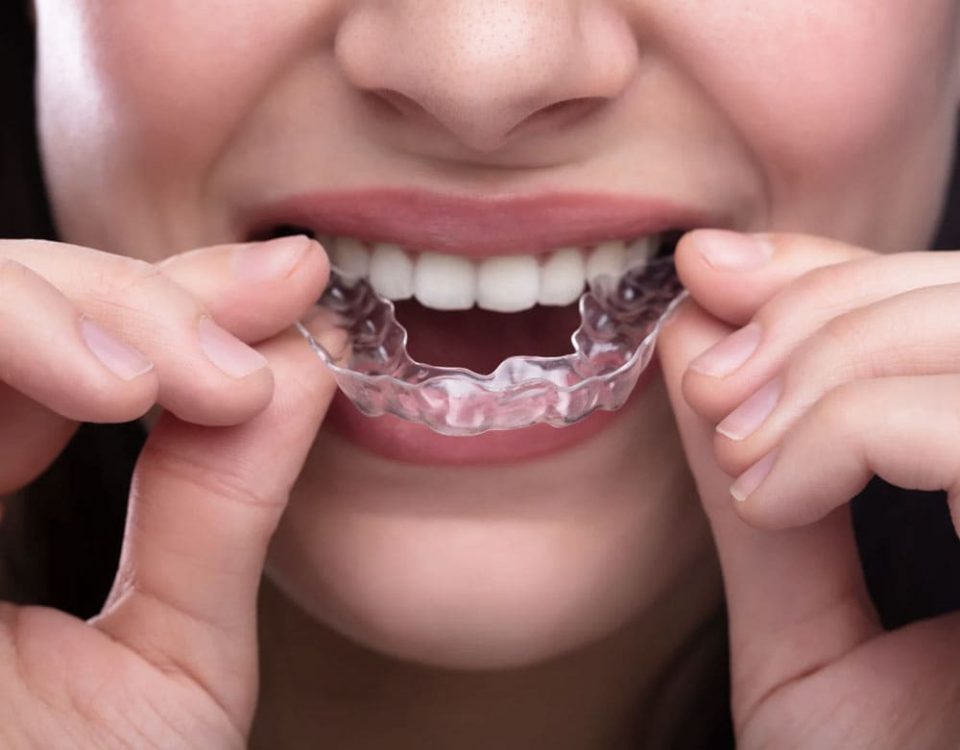 Temporomandibular Joint Diseases - Bruxism | Teeth Grinding | Dental ...
