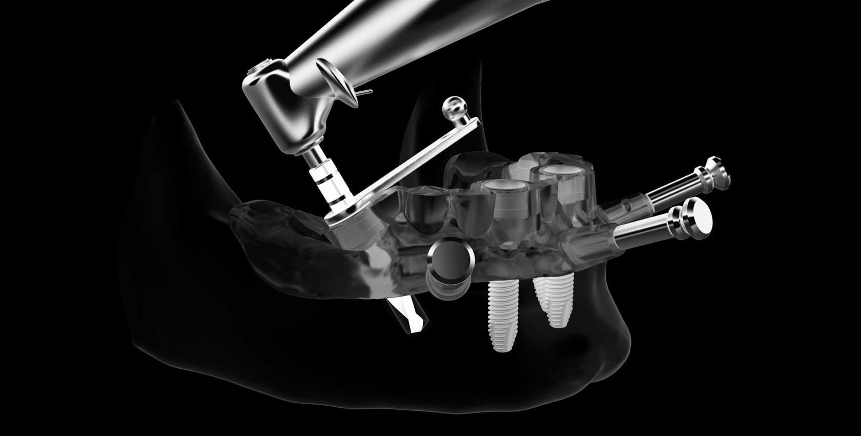 Seamless Implant - Medicadent | Biological and Holistic Dentistry ...