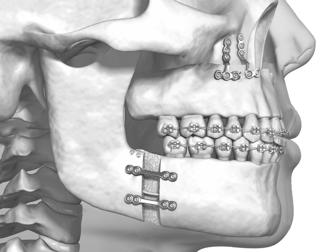 Orthognatic Surgery - Medicadent | Biological and Holistic Dentistry ...