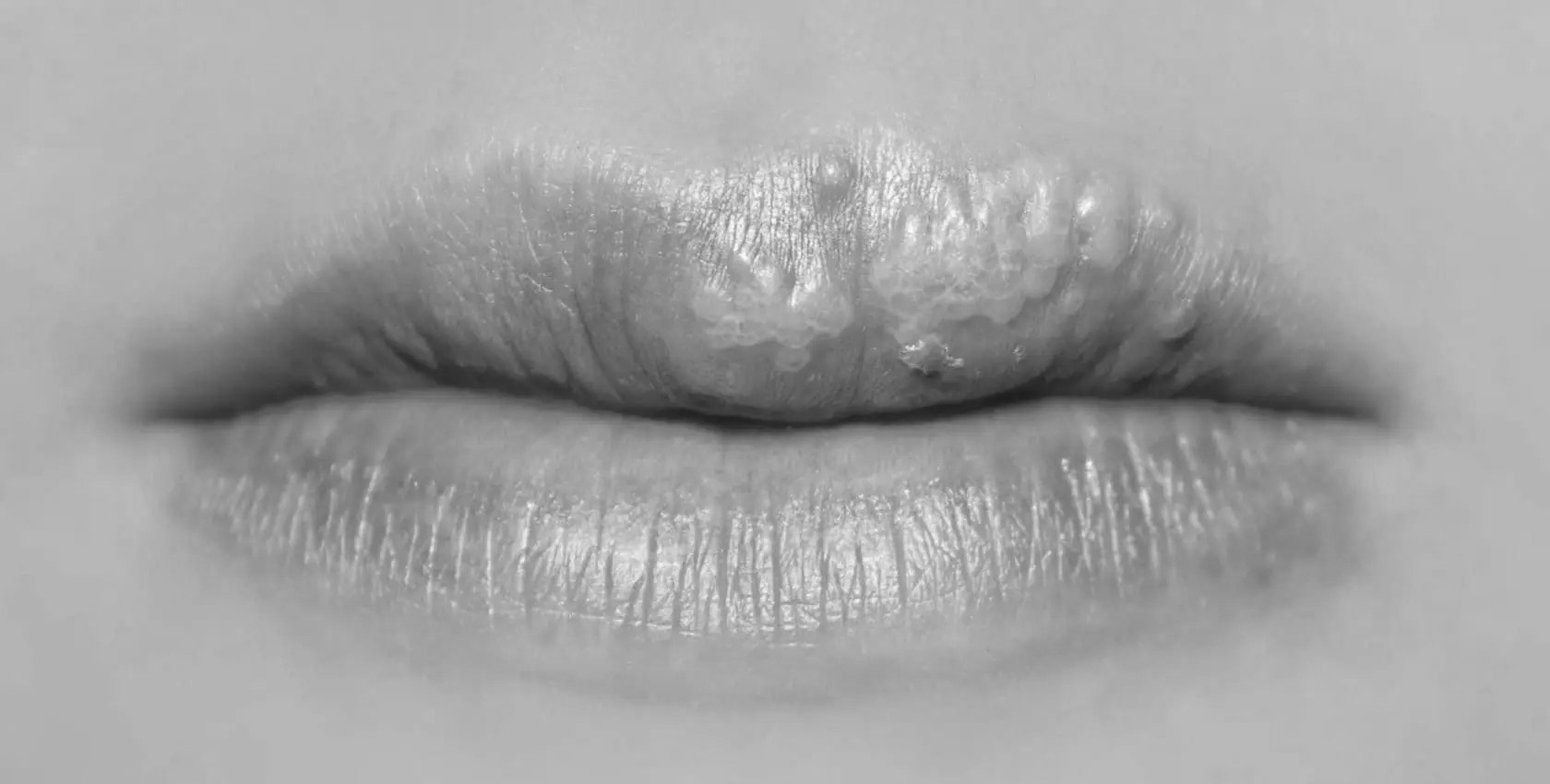 Aphthae - What Is Aphtha? How Is Aphtha Treated?