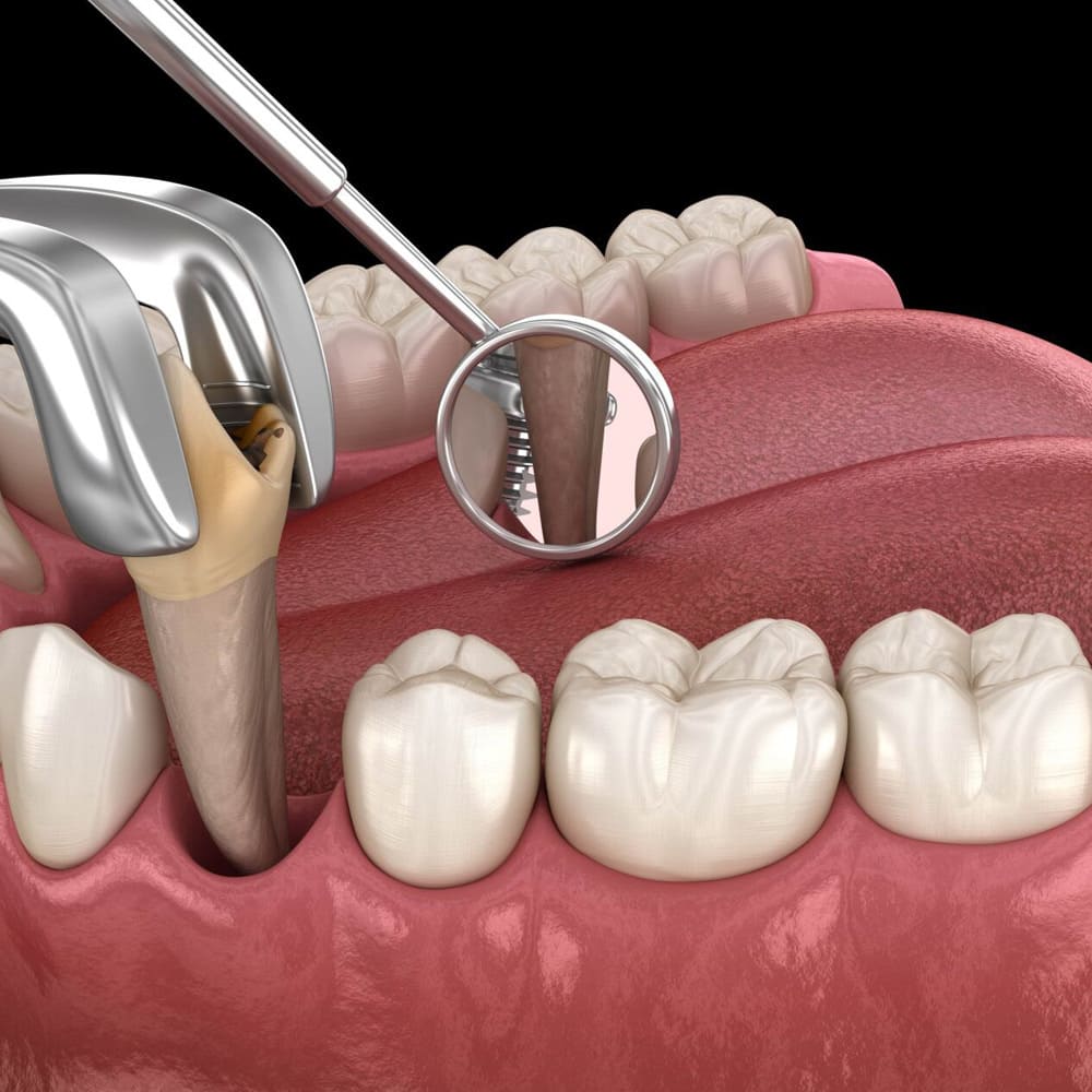 Tooth Extraction - Medicadent | Biological and Holistic Dentistry ...