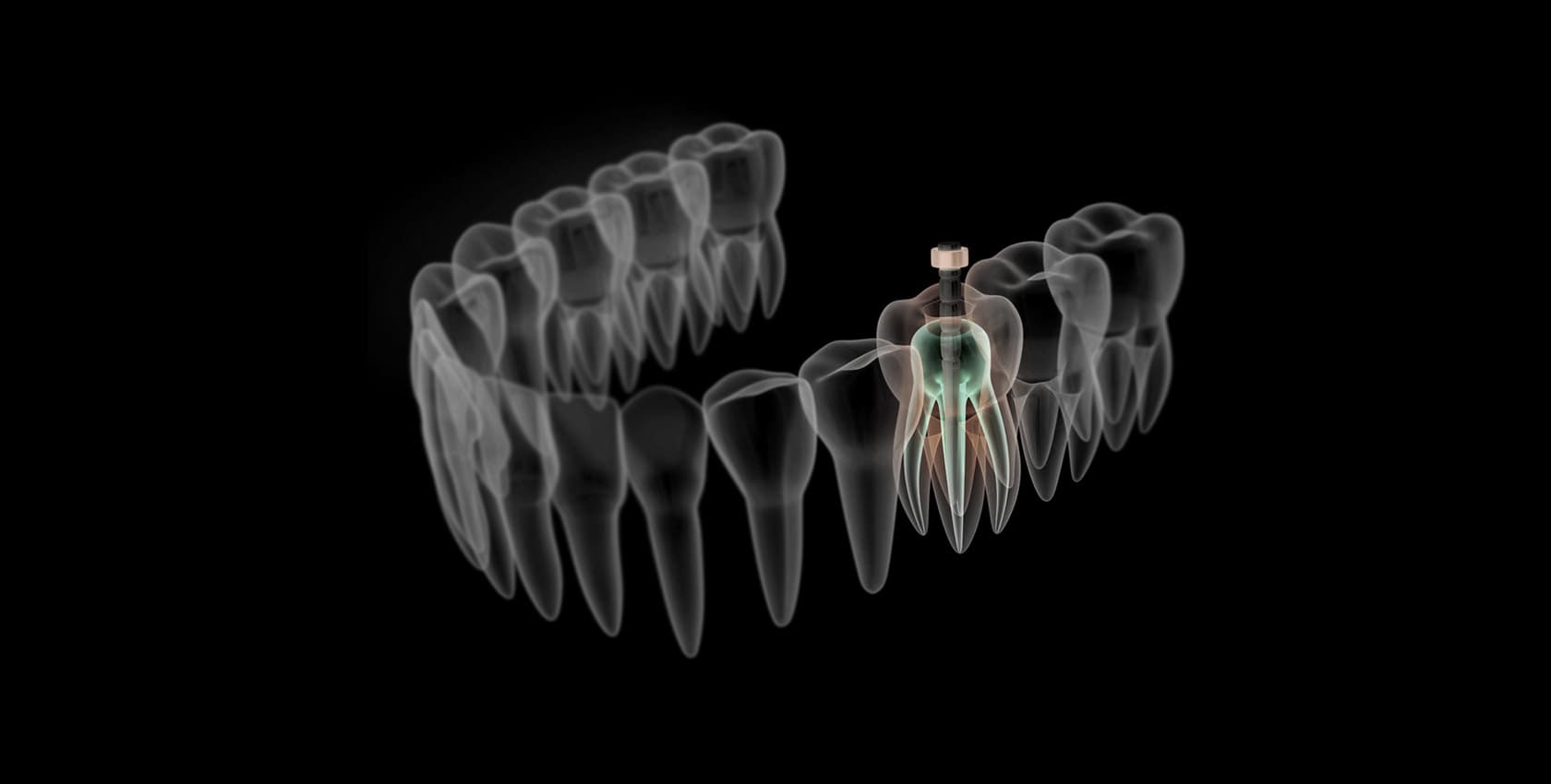 Fiber Post - Medicadent | Biological and Holistic Dentistry | Since 1988