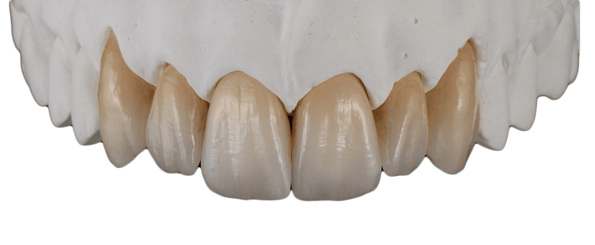 Monolithic Zirconium - Medicadent | Biological and Holistic Dentistry ...