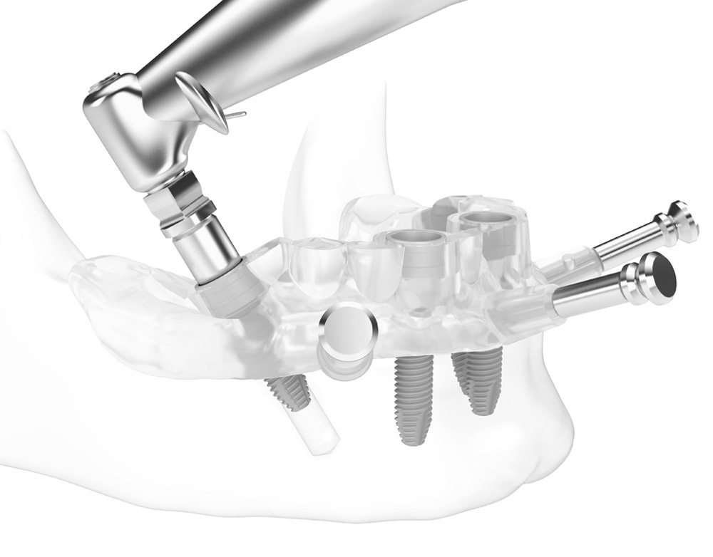 Guided Implantology - Medicadent | Biological and Holistic Dentistry ...