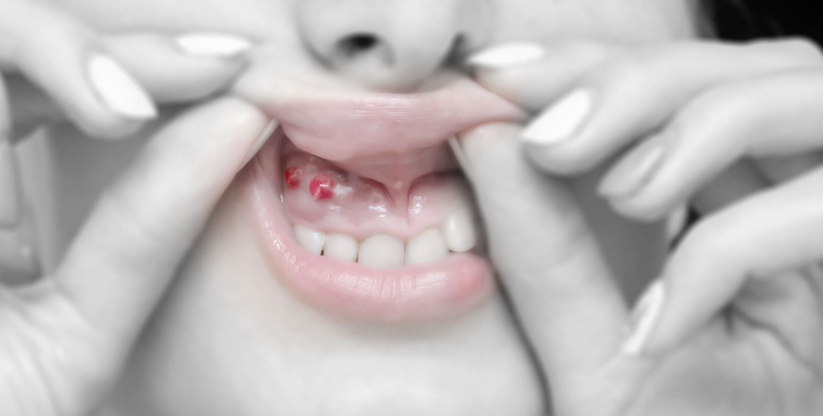 Dental | Diş Kistleri - Medicadent Ağız ve Diş Sağlığı Polikliniği